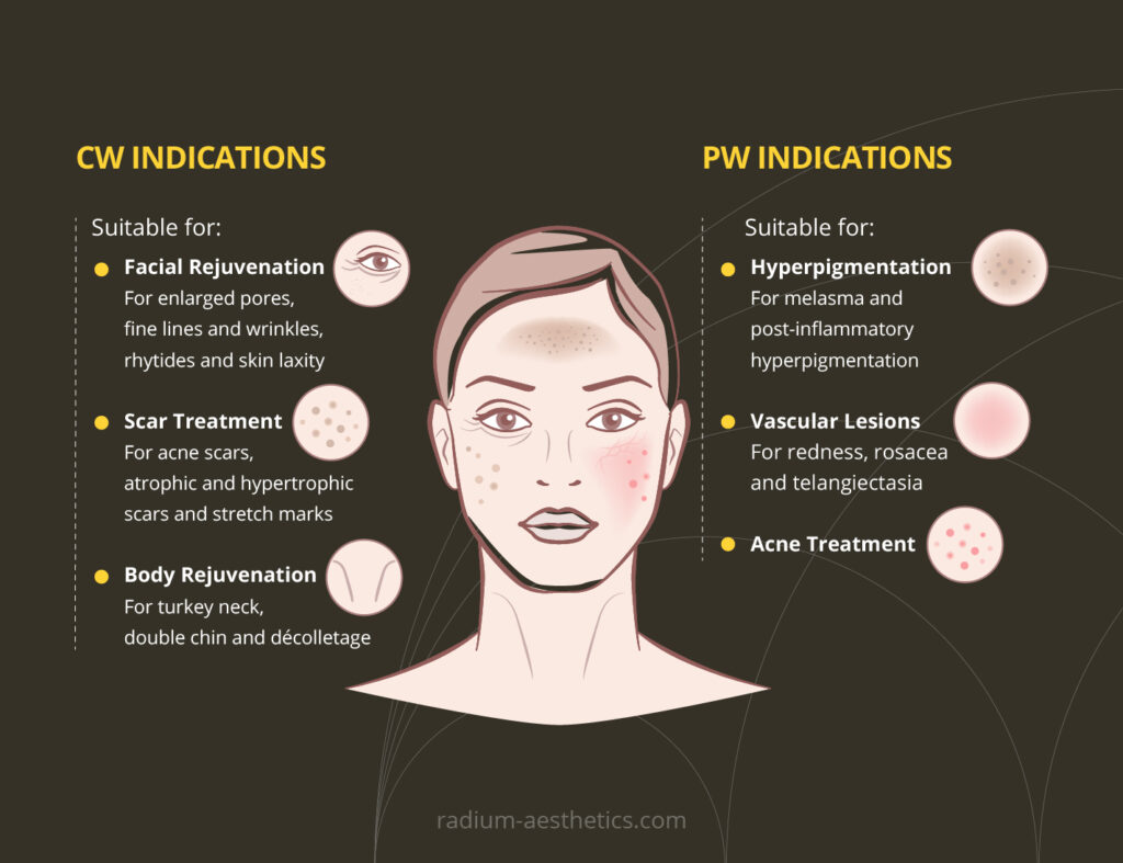 Pulsed Radiofrequency Microneedling for Melasma